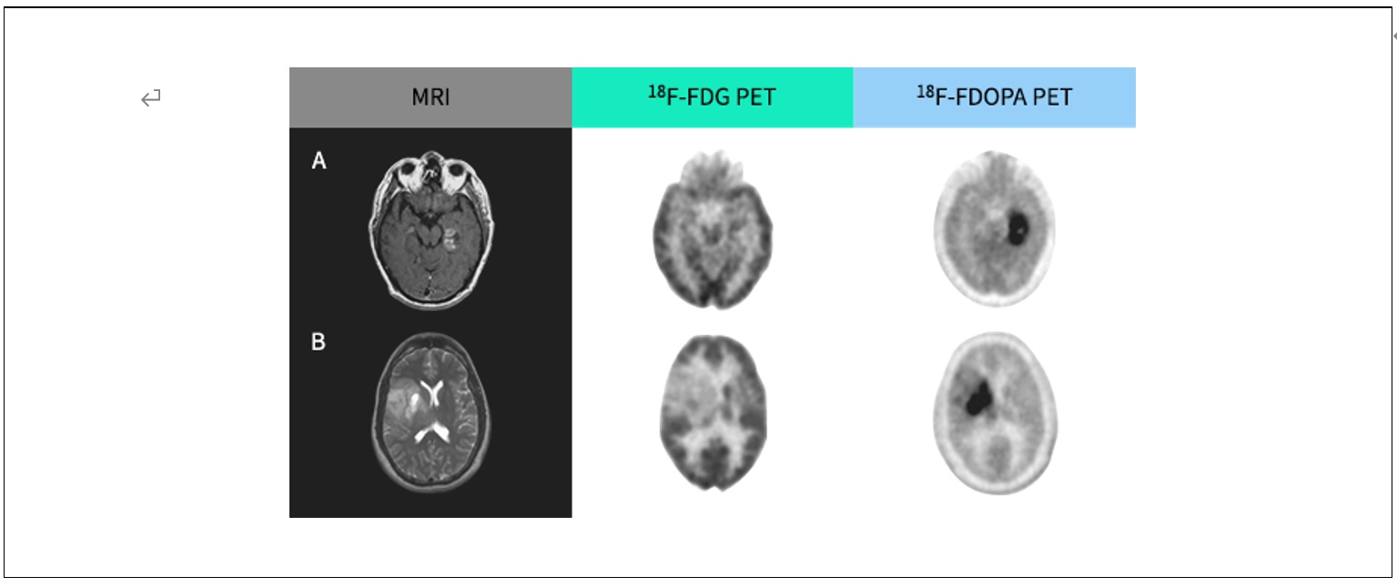 이미지: f-dopa pet 이미지 진단