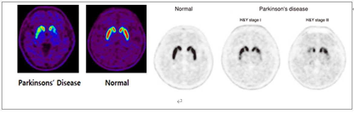 이미지: fp-cit pet 이미지 진단